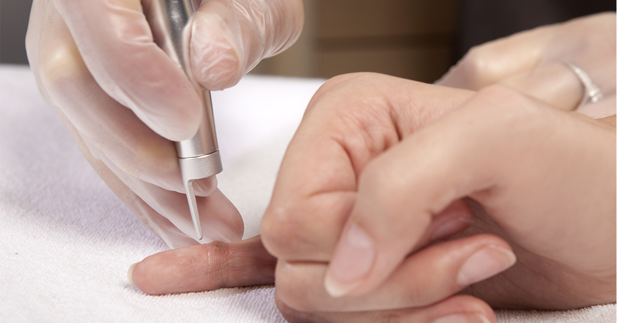 Vorter på hænderne | Sådan bekæmper du vorter på hånden